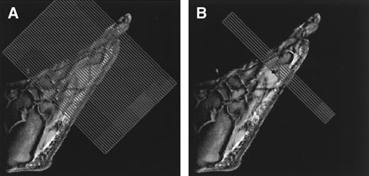 Intrinsic Muscle Atrophy and Toe Deformity in the Diabetic Neuropathic ...