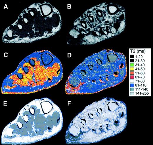 Intrinsic Muscle Atrophy and Toe Deformity in the Diabetic Neuropathic ...
