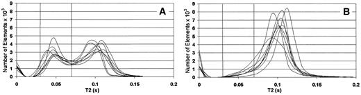 Intrinsic Muscle Atrophy and Toe Deformity in the Diabetic Neuropathic ...