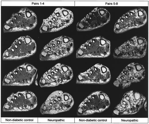 Intrinsic Muscle Atrophy and Toe Deformity in the Diabetic Neuropathic ...