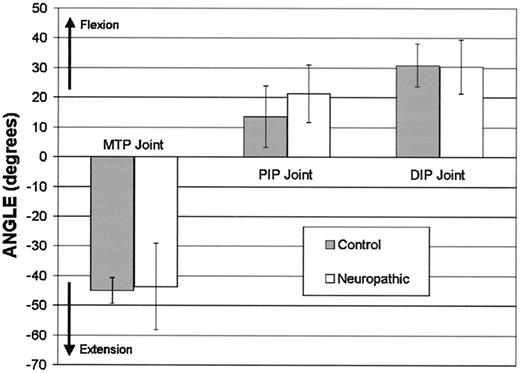 Intrinsic Muscle Atrophy and Toe Deformity in the Diabetic Neuropathic ...