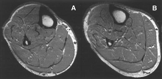 Intrinsic Muscle Atrophy and Toe Deformity in the Diabetic Neuropathic ...