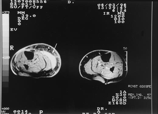Diabetic Muscle Infarction | Diabetes Care | American Diabetes Association