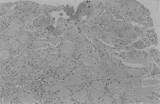 Diabetic Muscle Infarction | Diabetes Care | American Diabetes Association