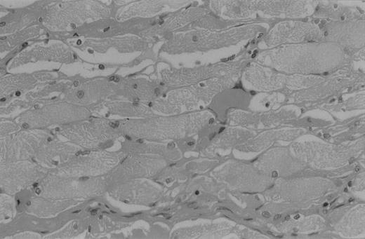 Diabetic Muscle Infarction | Diabetes Care | American Diabetes Association