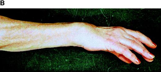 Charcot Neuroarthropathy of the Wrist in Type 1 Diabetes | Diabetes ...