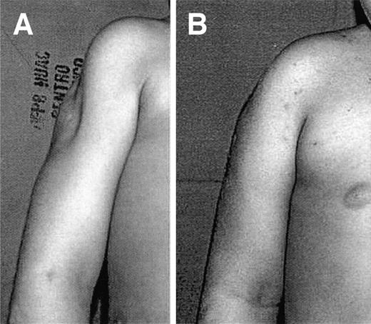 Human Insulin–Induced Lipoatrophy | Diabetes Care | American Diabetes ...