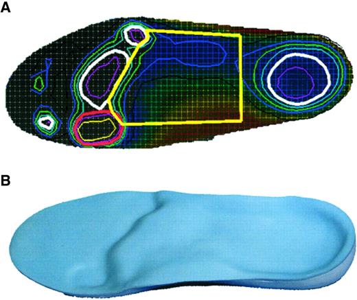 Custom Therapeutic Insoles Based on Both Foot Shape and Plantar ...