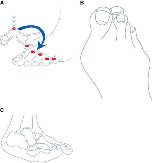 Comprehensive Foot Examination and Risk Assessment | Diabetes Care ...