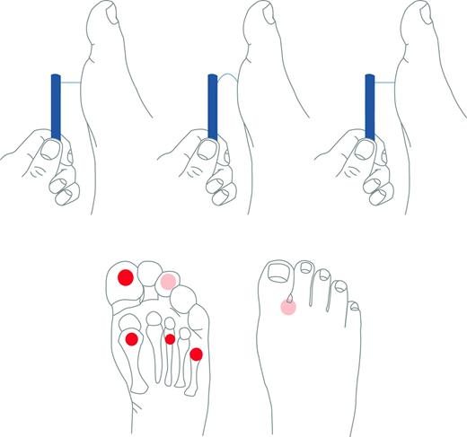 Comprehensive Foot Examination and Risk Assessment | Diabetes Care ...