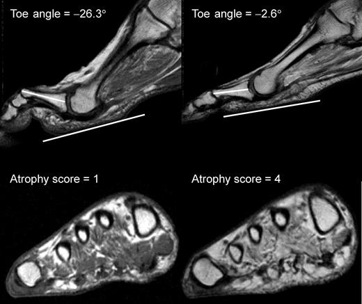 Role of Intrinsic Muscle Atrophy in the Etiology of Claw Toe Deformity ...