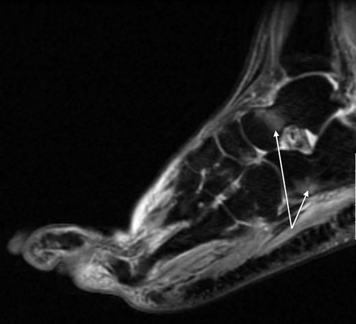 Midfoot and Hindfoot Bone Marrow Edema Identified By Magnetic Resonance ...