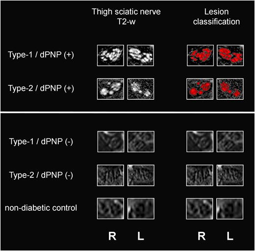 Proximal Neuropathic Lesions in Distal Symmetric Diabetic ...