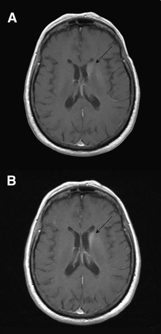 A Case of Hemichorea-Hemiballismus Due to Nonketotic Hyperglycemia ...