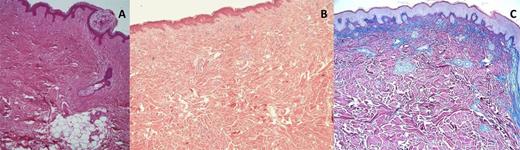 Improvement in Clinical Symptoms of Scleredema Diabeticorum by ...