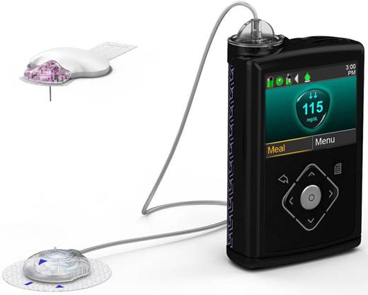 Day and Night Closed-Loop Control Using the Integrated Medtronic Hybrid ...