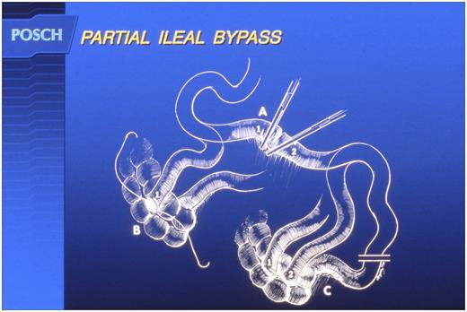 Metabolic (Bariatric and Nonbariatric) Surgery for Type 2 Diabetes: A ...