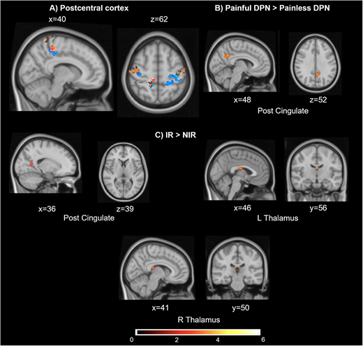 Structural Brain Alterations In Key Somatosensory And Nociceptive Regions In Diabetic Peripheral