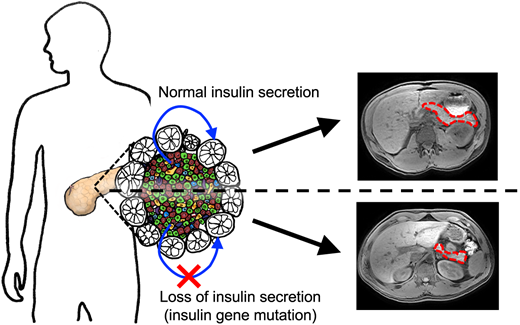 Insulin Deficiency From Insulin Gene Mutation Leads to Smaller Pancreas ...