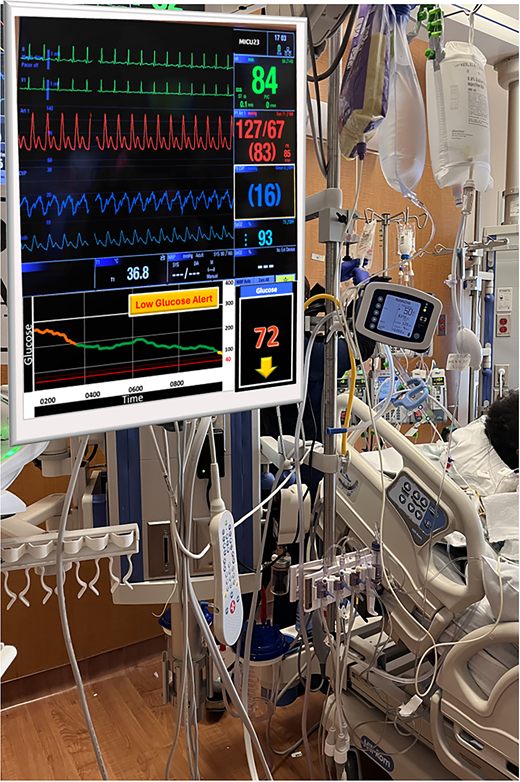 Real-time Continuous Glucose Monitoring in the Intensive Care Unit: The ...