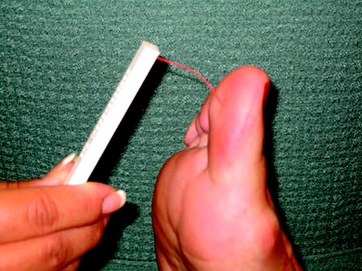 Evaluation and Treatment of Diabetic Foot Ulcers | Clinical Diabetes ...