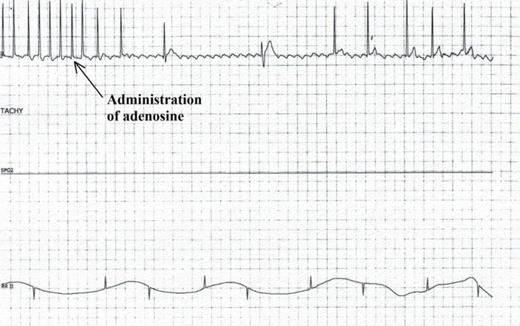 Supraventricular Tachycardia With Underlying Atrial Flutter in a ...