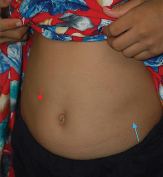 Concurrence of Lipoatrophy and Lipohypertrophy in Children With Type 1 ...