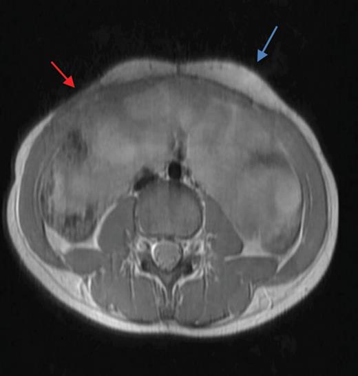 Concurrence of Lipoatrophy and Lipohypertrophy in Children With Type 1 ...
