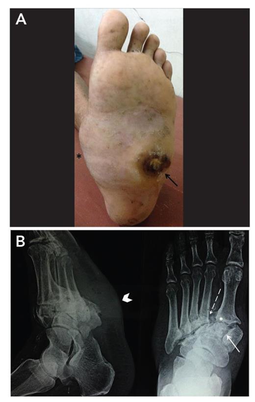 Clinical and Roentgenological Profiles of Five Patterns of Charcot Foot ...