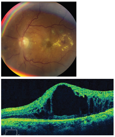 How to Interpret a Diabetes-Related Eye Examination Report | Compendia ...