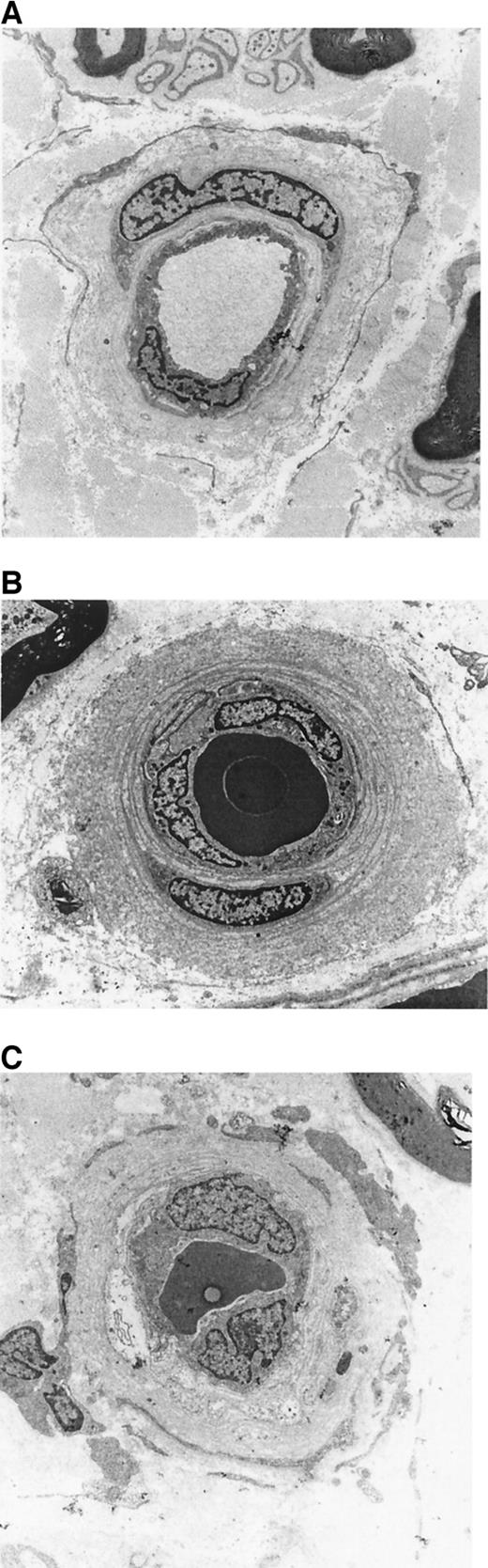 Endoneurial Capillary Abnormalities Presage Deterioration of Glucose ...