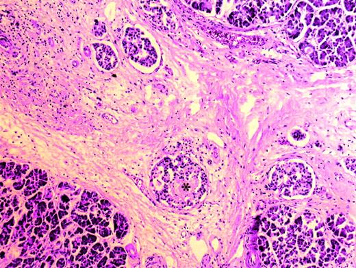 Prevalence and Clinicopathological Characteristics of Islet Amyloid in ...