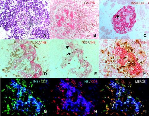 Screening for Insulitis in Adult Autoantibody-Positive Organ Donors ...