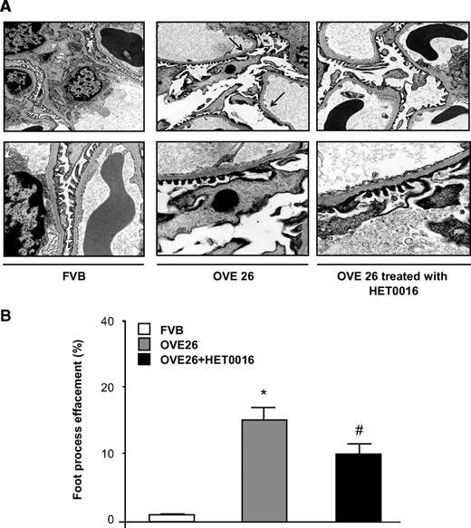 Mechanisms of Podocyte Injury in Diabetes | Diabetes | American ...
