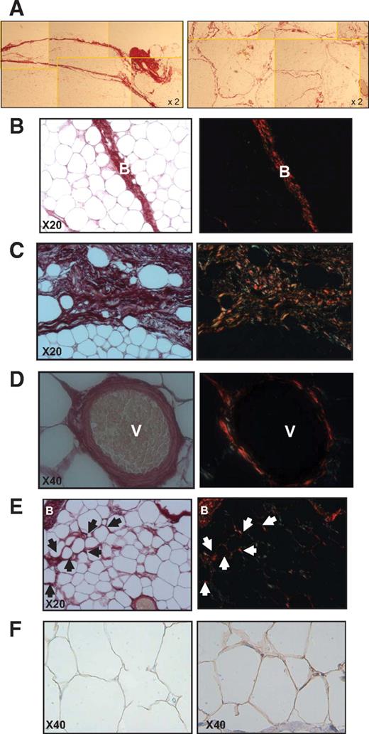 Fibrosis in Human Adipose Tissue: Composition, Distribution, and Link ...