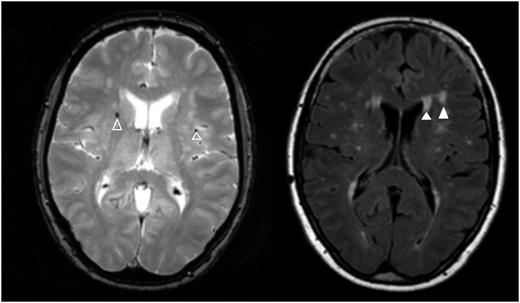 Brain Changes Underlying Cognitive Dysfunction in Diabetes: What Can We ...