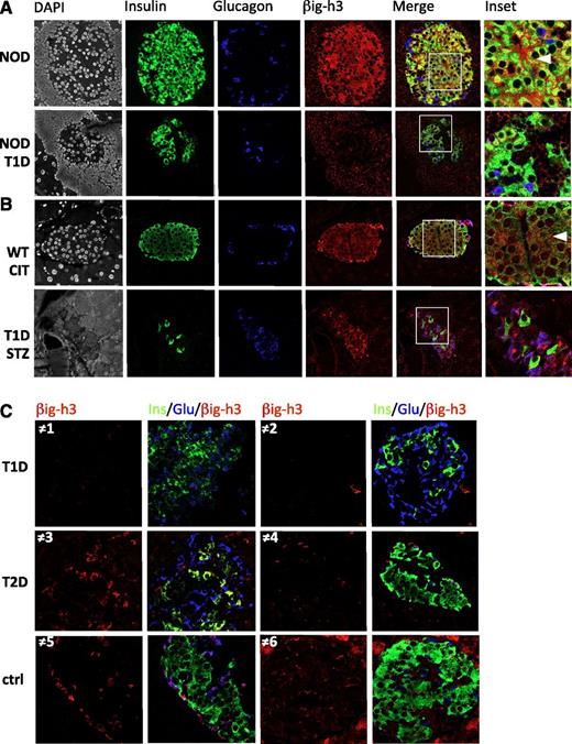 βig-h3 Represses T-Cell Activation in Type 1 Diabetes | Diabetes ...