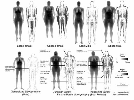 Fat Shadows from DEXA for Documentation of Fat Distribution in Patients ...
