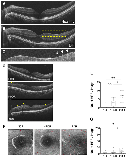 Identifying Hyperreflective Foci in Diabetic Retinopathy via VEGF ...