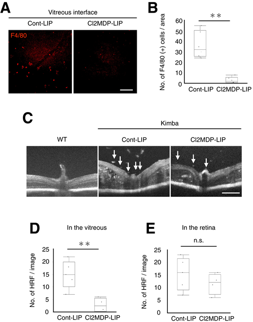 Identifying Hyperreflective Foci in Diabetic Retinopathy via VEGF ...