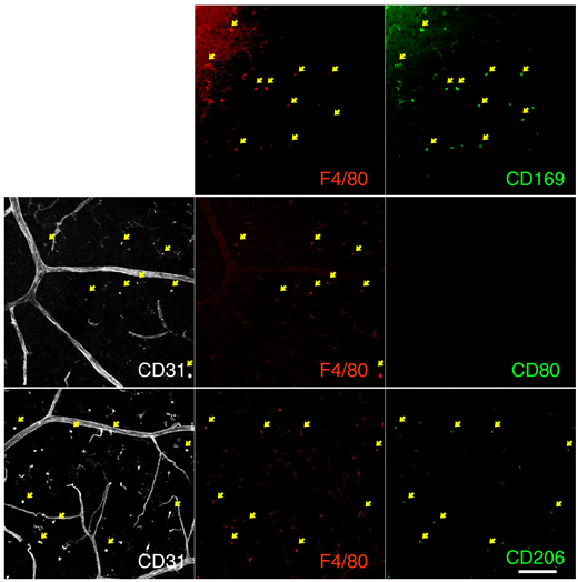 Identifying Hyperreflective Foci in Diabetic Retinopathy via VEGF ...