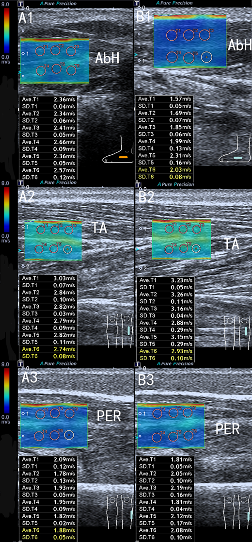 Morphological and Mechanical Properties of Lower-Limb Muscles in Type 2 ...