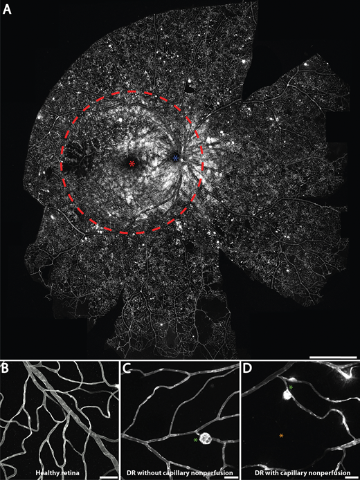 Differentiating Microaneurysm Pathophysiology in Diabetic Retinopathy ...