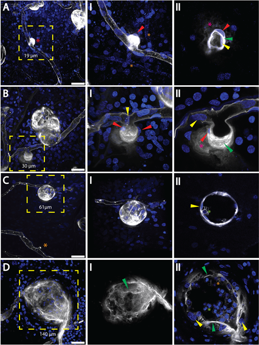 Differentiating Microaneurysm Pathophysiology in Diabetic Retinopathy ...