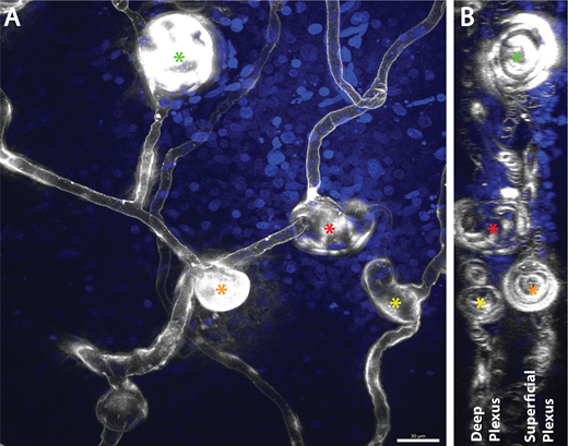 Differentiating Microaneurysm Pathophysiology in Diabetic Retinopathy ...