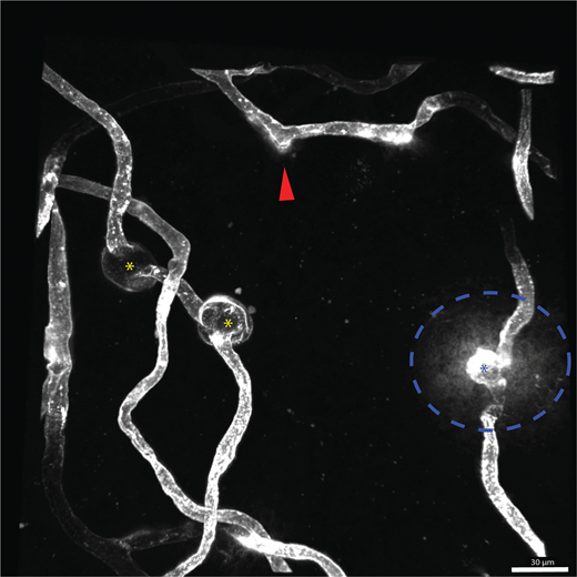 Differentiating Microaneurysm Pathophysiology in Diabetic Retinopathy ...