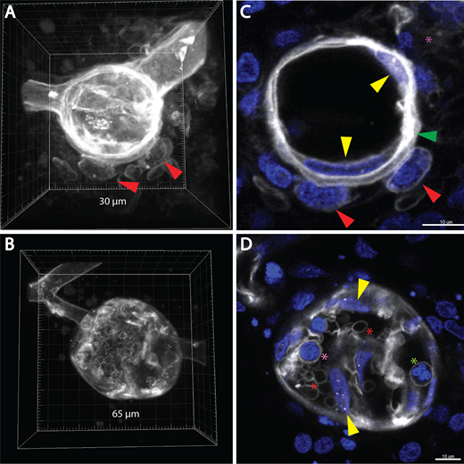 Differentiating Microaneurysm Pathophysiology in Diabetic Retinopathy ...