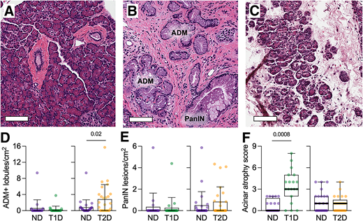 Exocrine Pancreas in Type 1 and Type 2 Diabetes: Different Patterns of ...