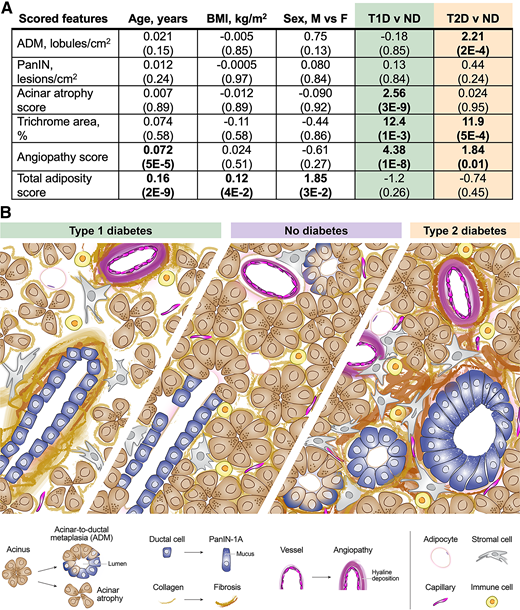 Exocrine Pancreas in Type 1 and Type 2 Diabetes: Different Patterns of ...
