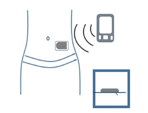 A Clinical Overview of Insulin Pump Therapy for the Management of ...